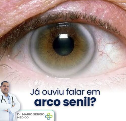 Arco Senil: sinal nos olhos pode indicar excesso de colesterol | Repórter Coragem